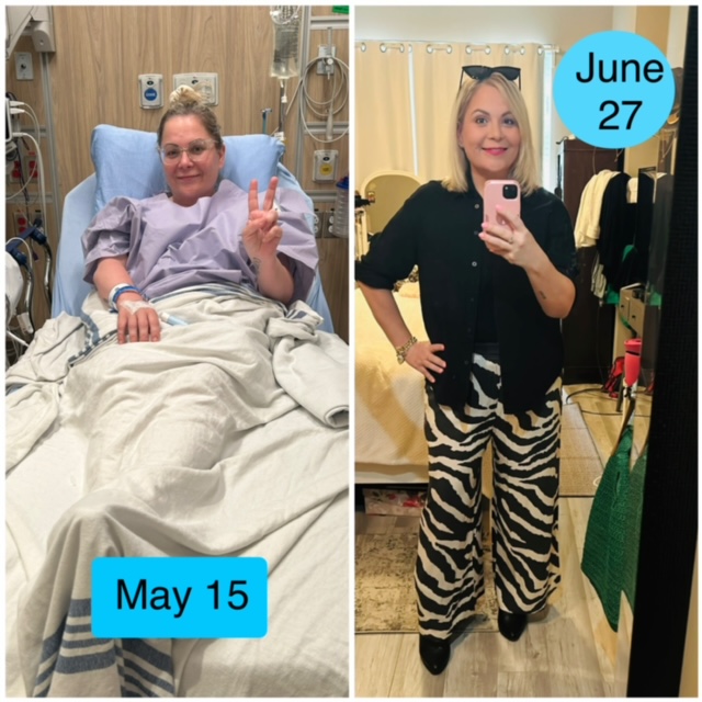 Having a stoma revision & hernia repair: A patient's perspective ...
